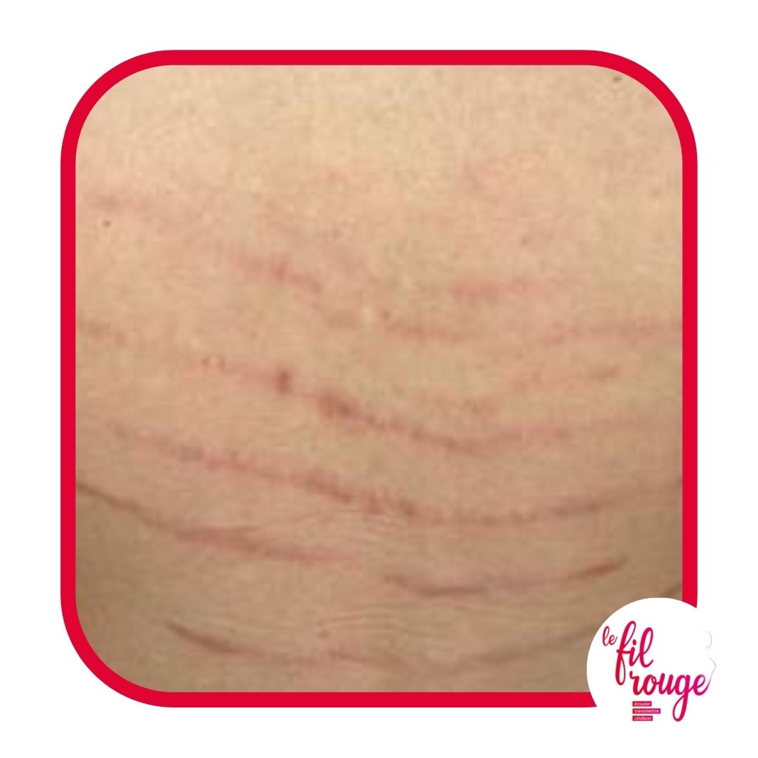 Vergétures - Le fil rouge